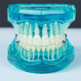 Sapphire Bracket System - UKORTHODONTIC